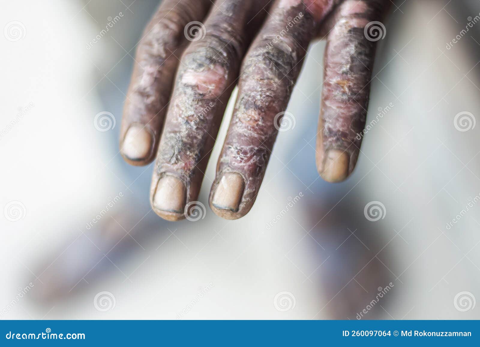 Five Fingers of One Hand Were Burnt and Bruised and the Background Blur ...