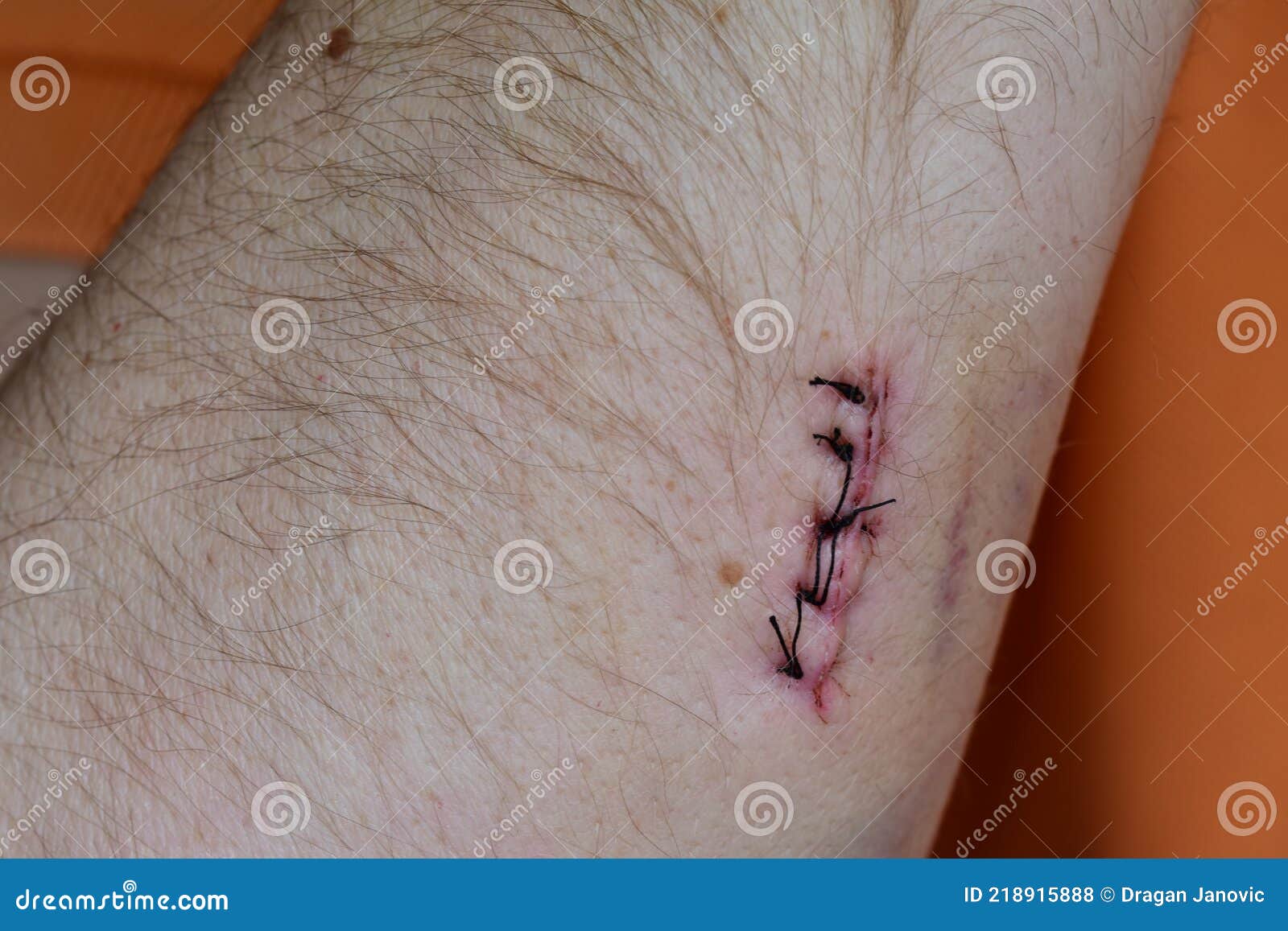 Five Stitches on the Forearm Stock Photo - Image of close, suture ...