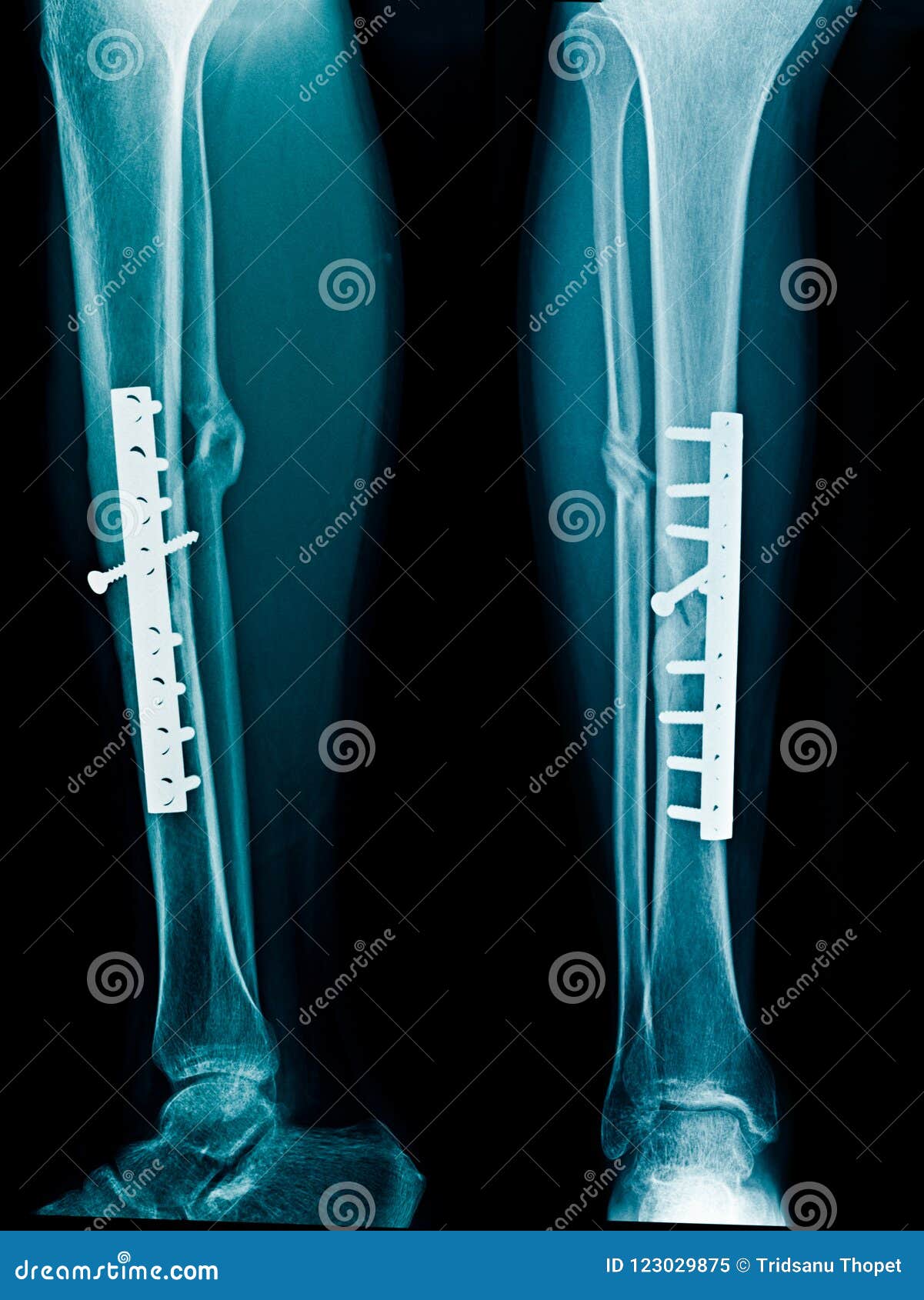 Fixation tibia bone stock image. Image of accident, fibular - 123029875