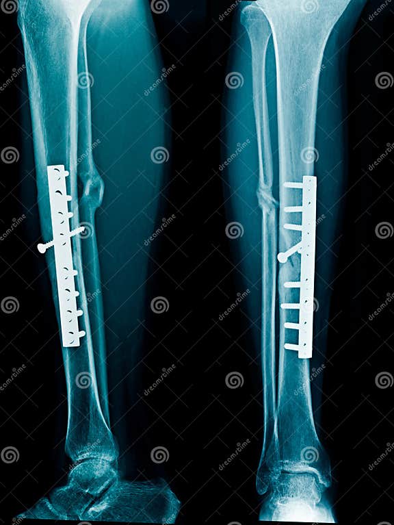 Fixation tibia bone stock image. Image of accident, fibular - 123029875