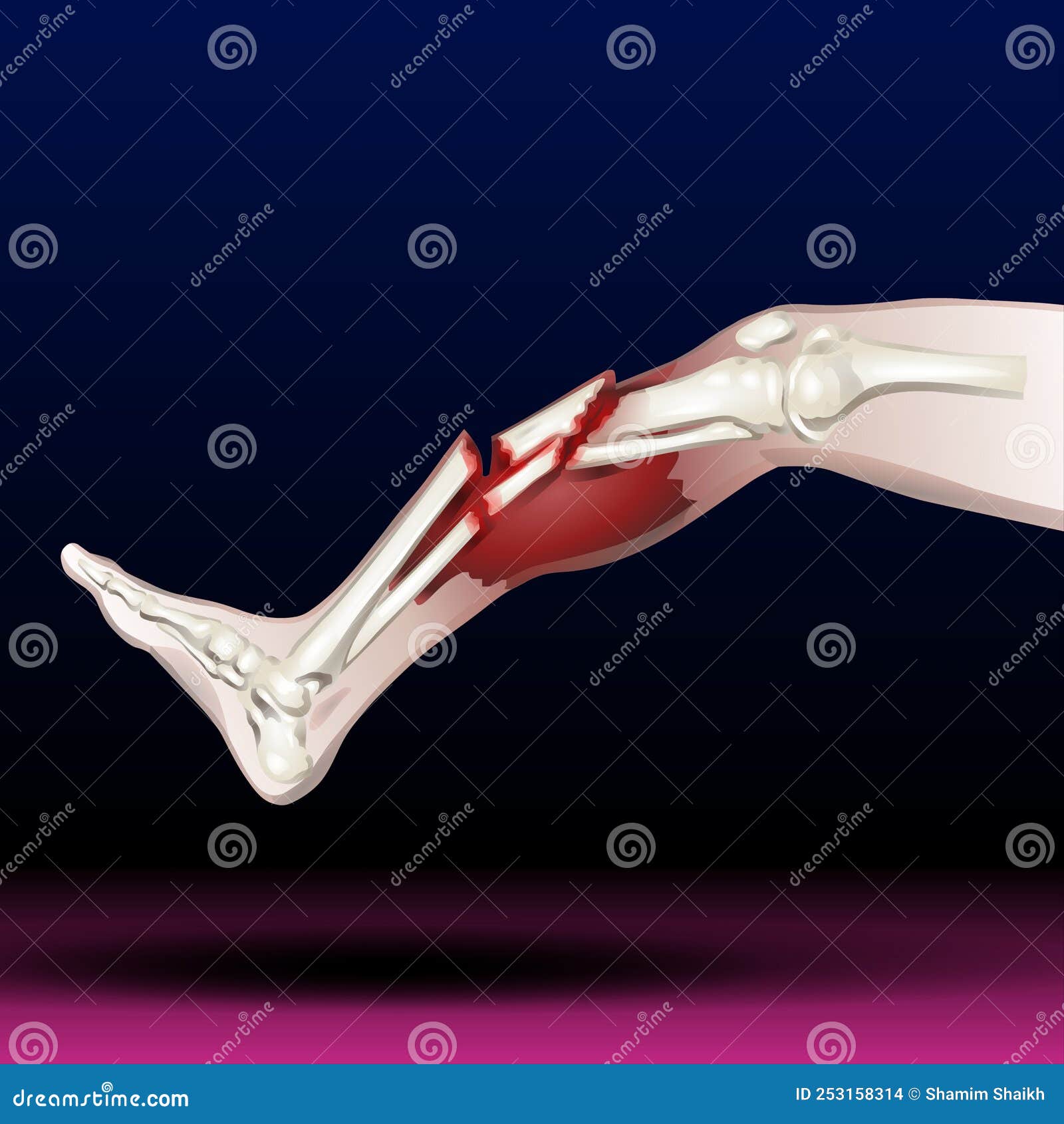 Leg Bone Fracture - Illustration - Healthcare - Science - Medical ...