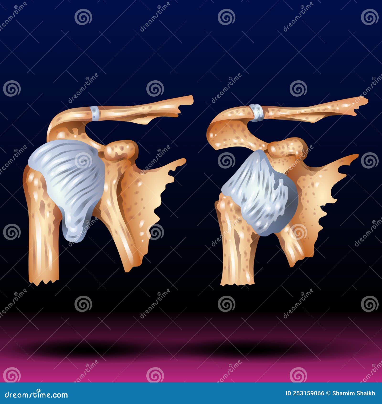 Shoulder Dislocation - Human Skeleton, Bone Anatomy, Artwork ...