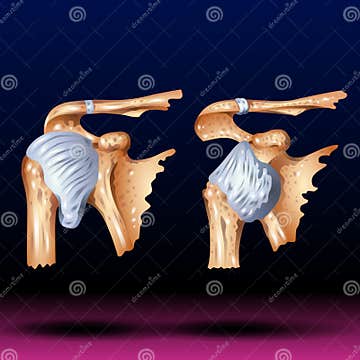 Shoulder Dislocation - Human Skeleton, Bone Anatomy, Artwork ...