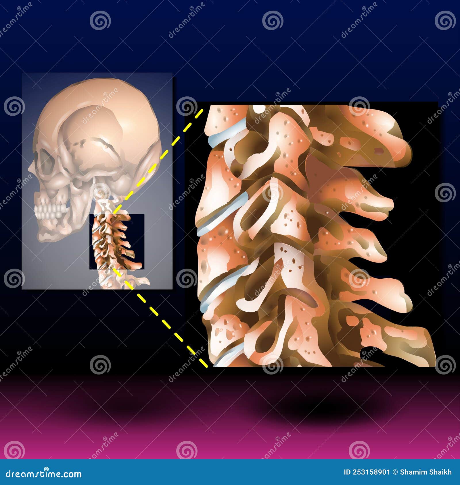 Spinal Stenosis Vector Illustration. Labeled Medical Scheme. Diagram ...