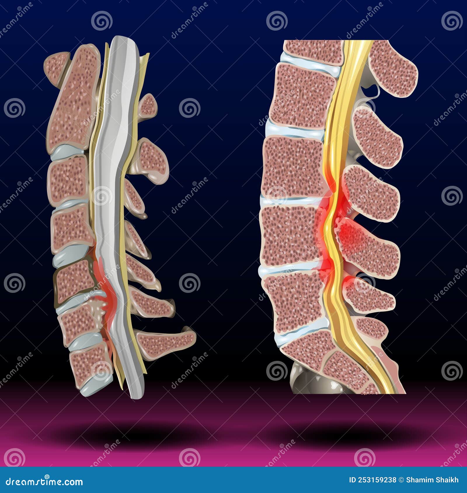 Spinal Stenosis Symbol Of Spine Curvatures Or Unhealthy Backbones Human Spine Anatomy Stock
