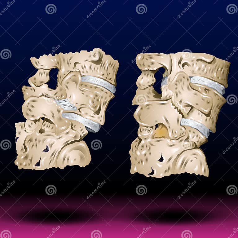 Spondylolisthesis - Human Anatomy - Healthcare - Science Stock ...
