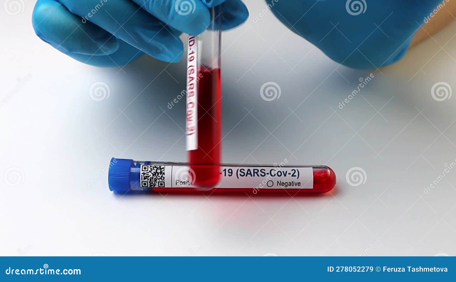 Flasks with Blood Tests for Monkey Pox Virus Positive and Negative ...