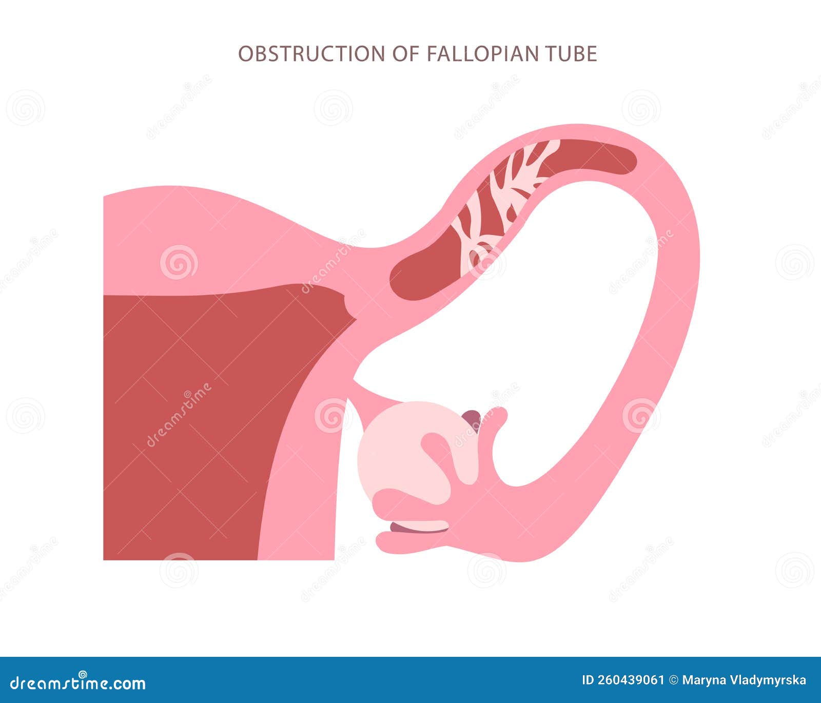 Flat Chart Of Fallopian Tube Obstructed Blockage Of Womb Tube High Magnification Scheme Stock