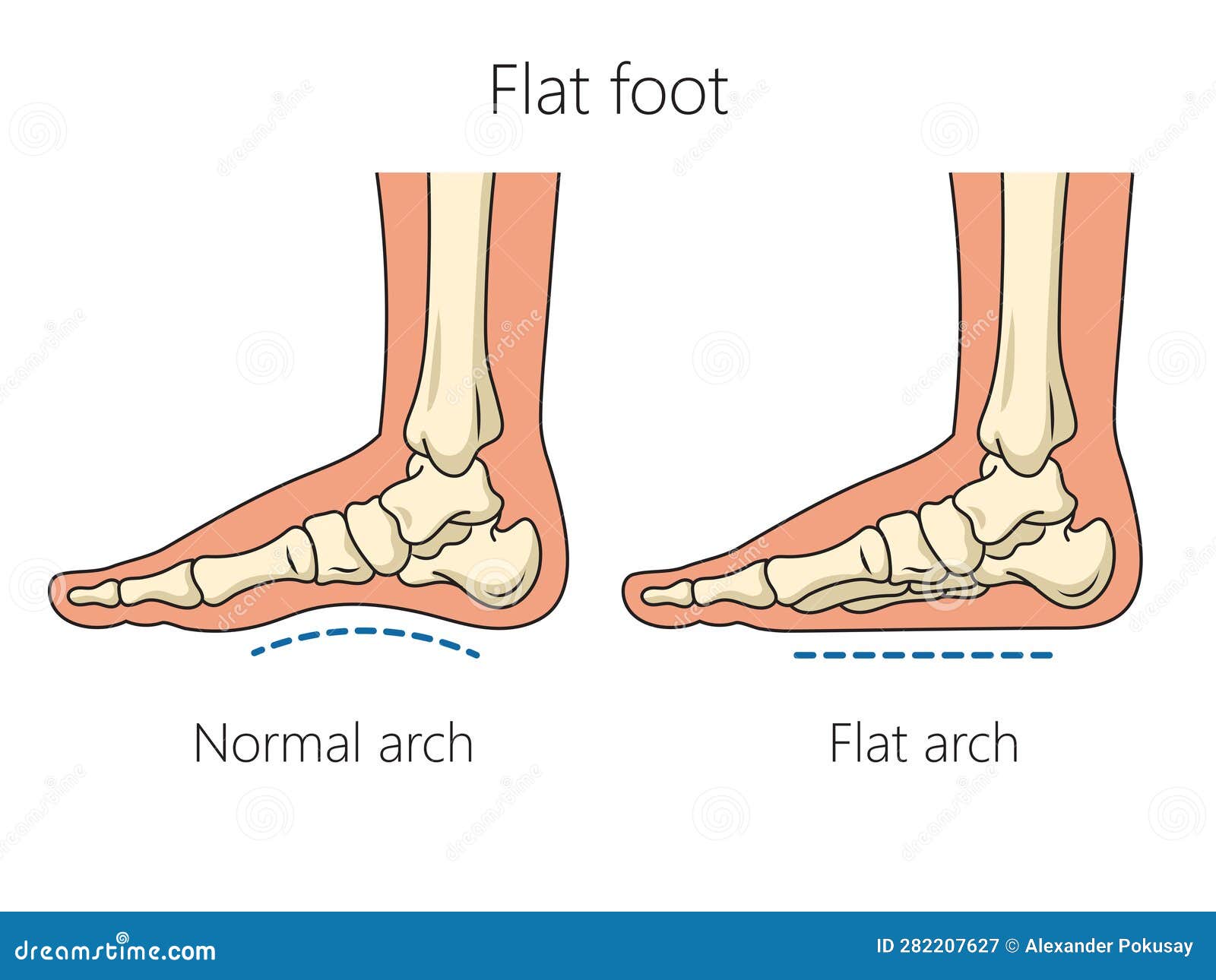 Flat Feet Bones Schematic Science Medical Image Stock Illustration ...