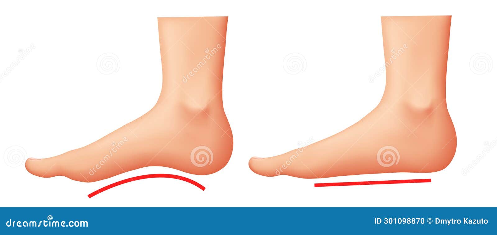 Flat Feet. Normal Foot and Flat Foot Stock Vector - Illustration of ...