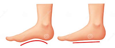 Flat Feet. Normal Foot and Flat Foot Stock Vector - Illustration of ...