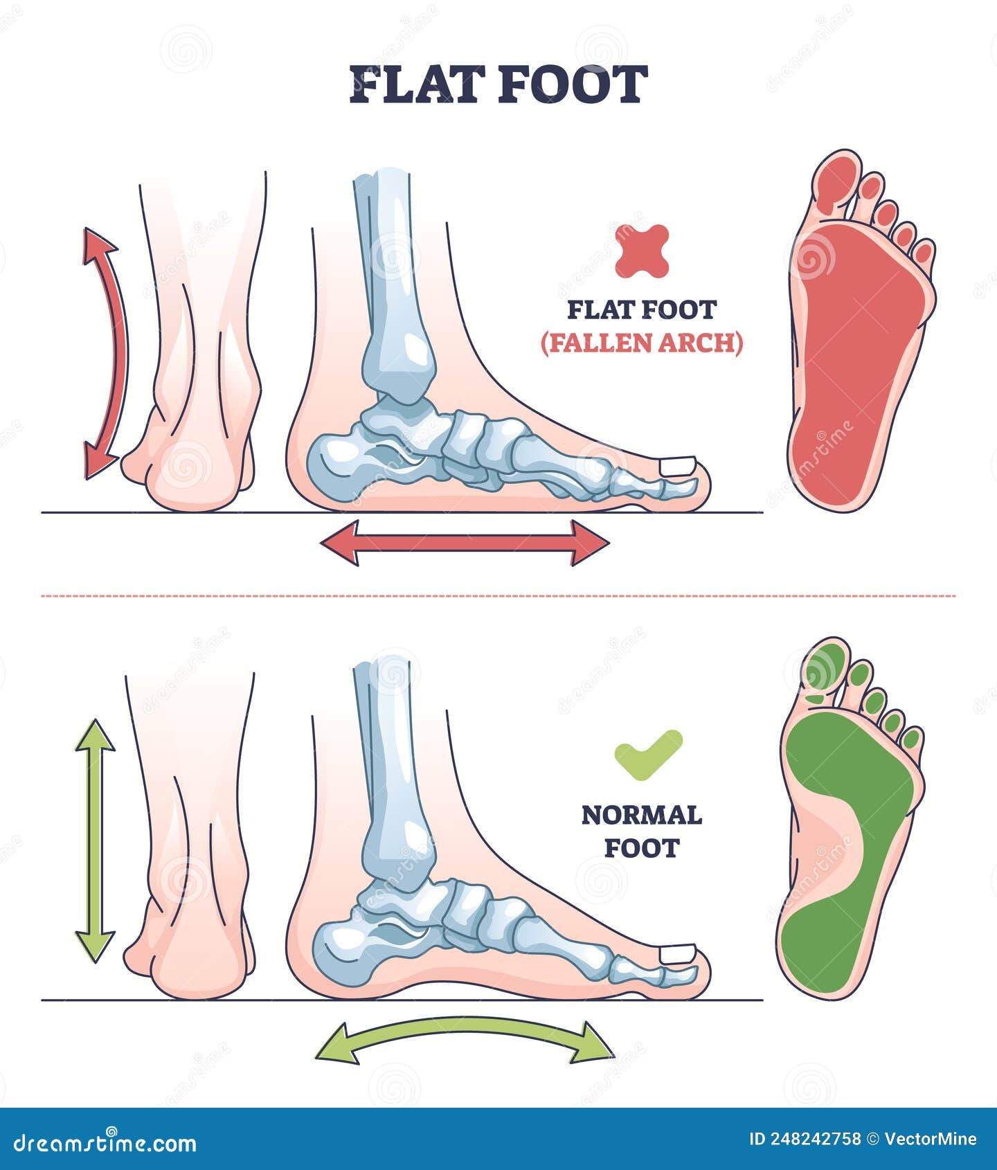 Flat Foot Pathology with Fallen and Normal Arch Comparison Outline ...