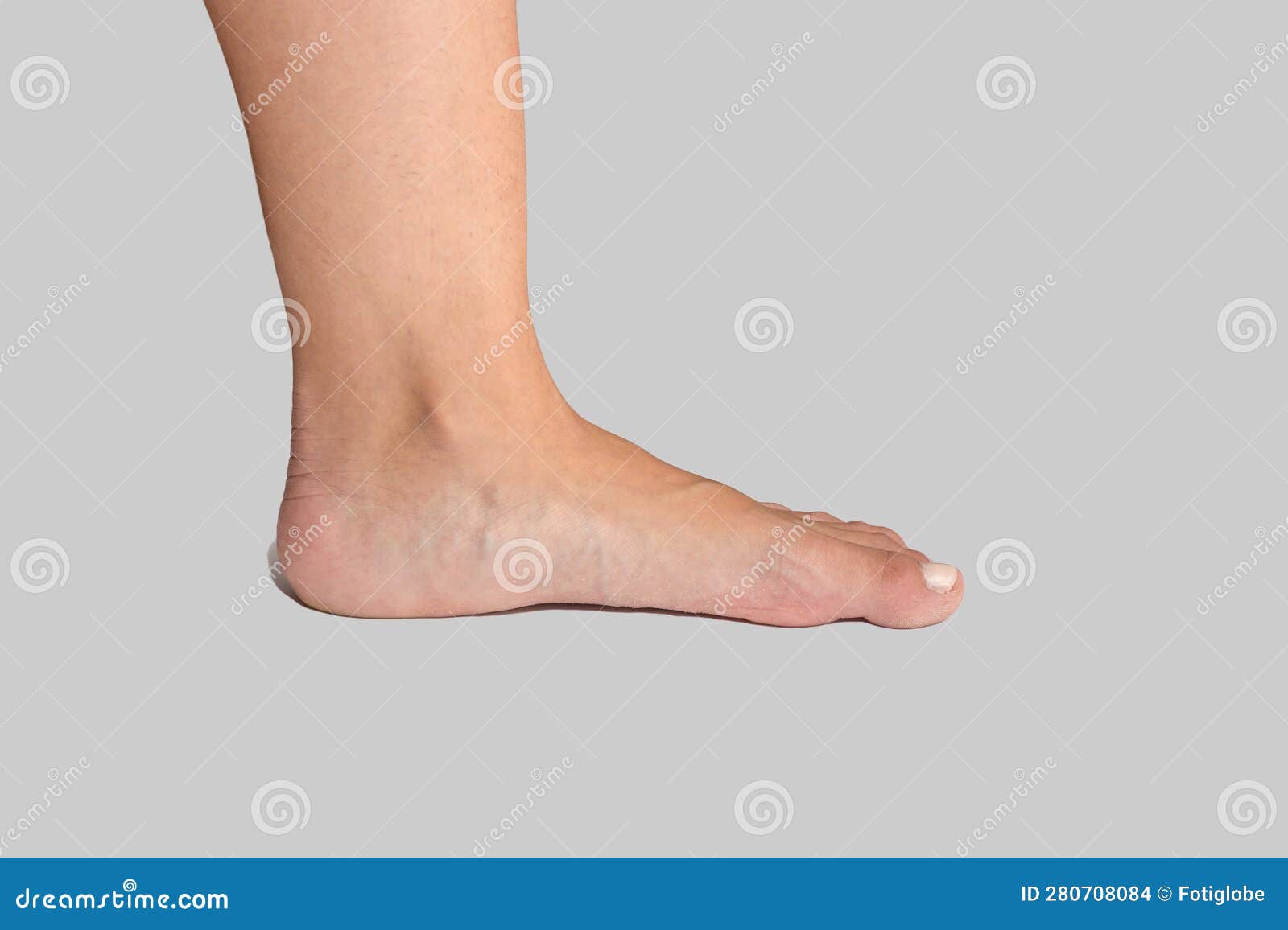 Flat Foot of Woman Showing Missing Arch Which Can Cause Misalignment ...