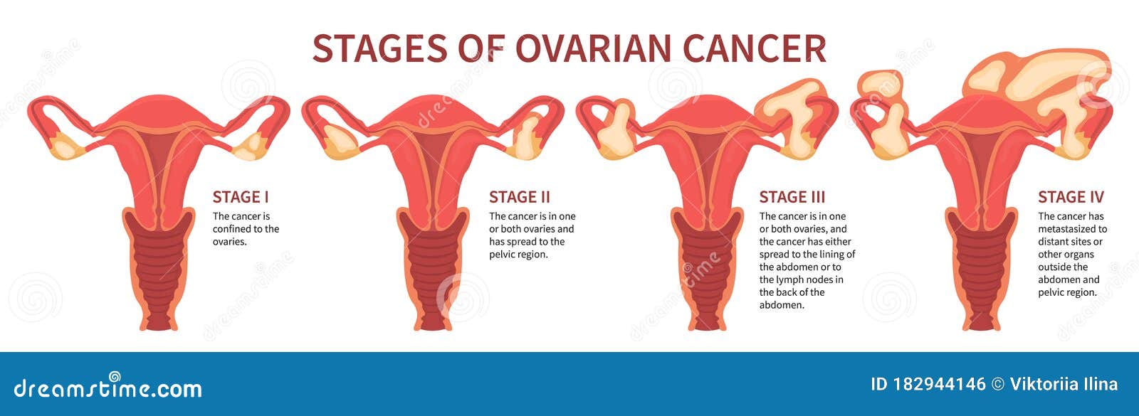 Ovarian Cancer Staging