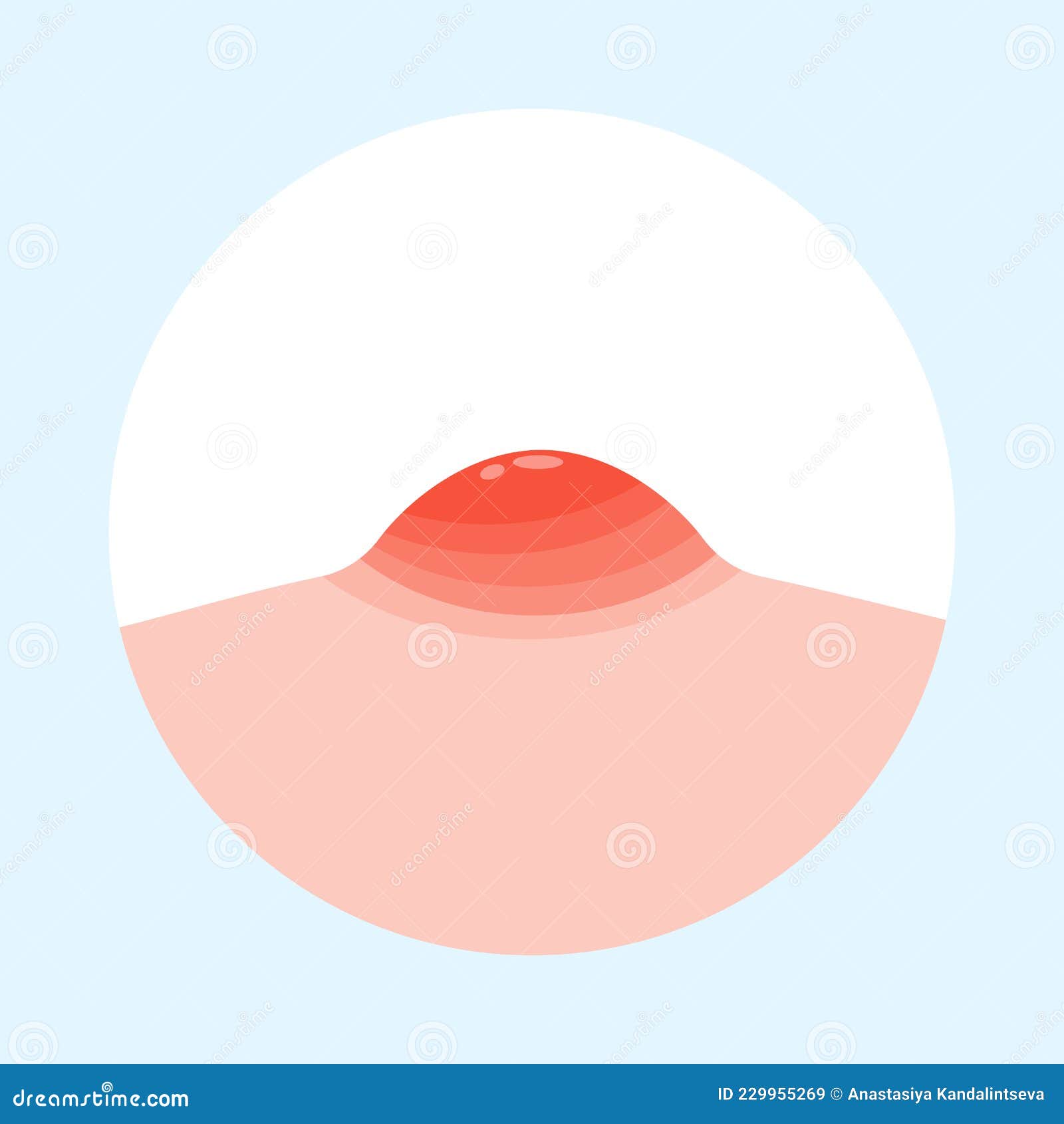 Flat Vector Illustration of Pimple on Skin. Pimple on Face Stock Vector ...
