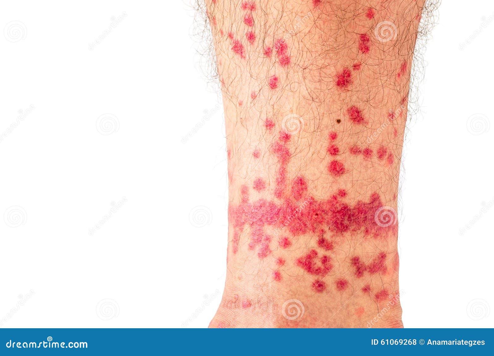 Flea Bites on Human leg stock photo. Image of skin, scab - 61069268
