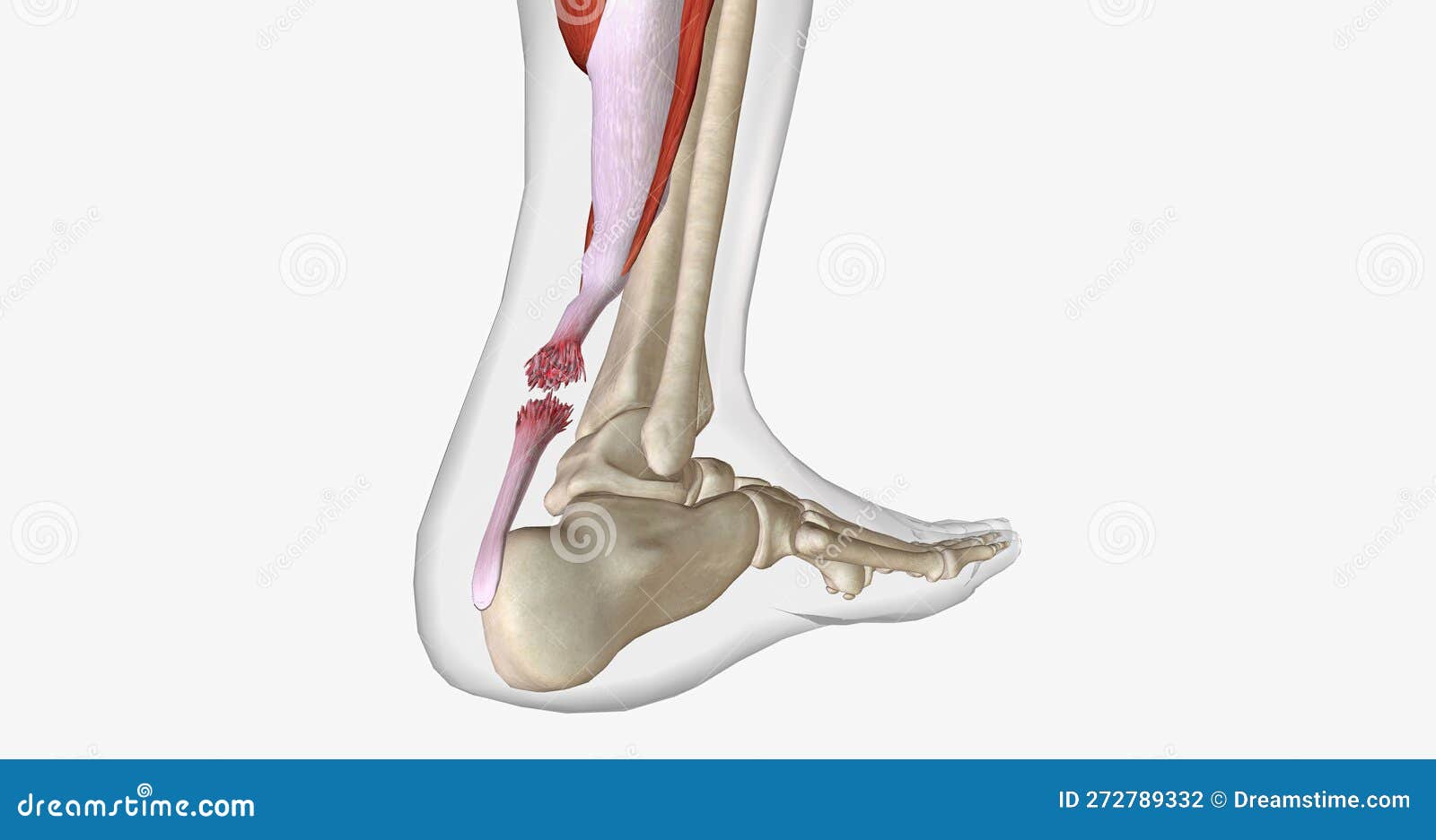 Flexion and Extension with Torn Achilles Tendon Stock Illustration ...