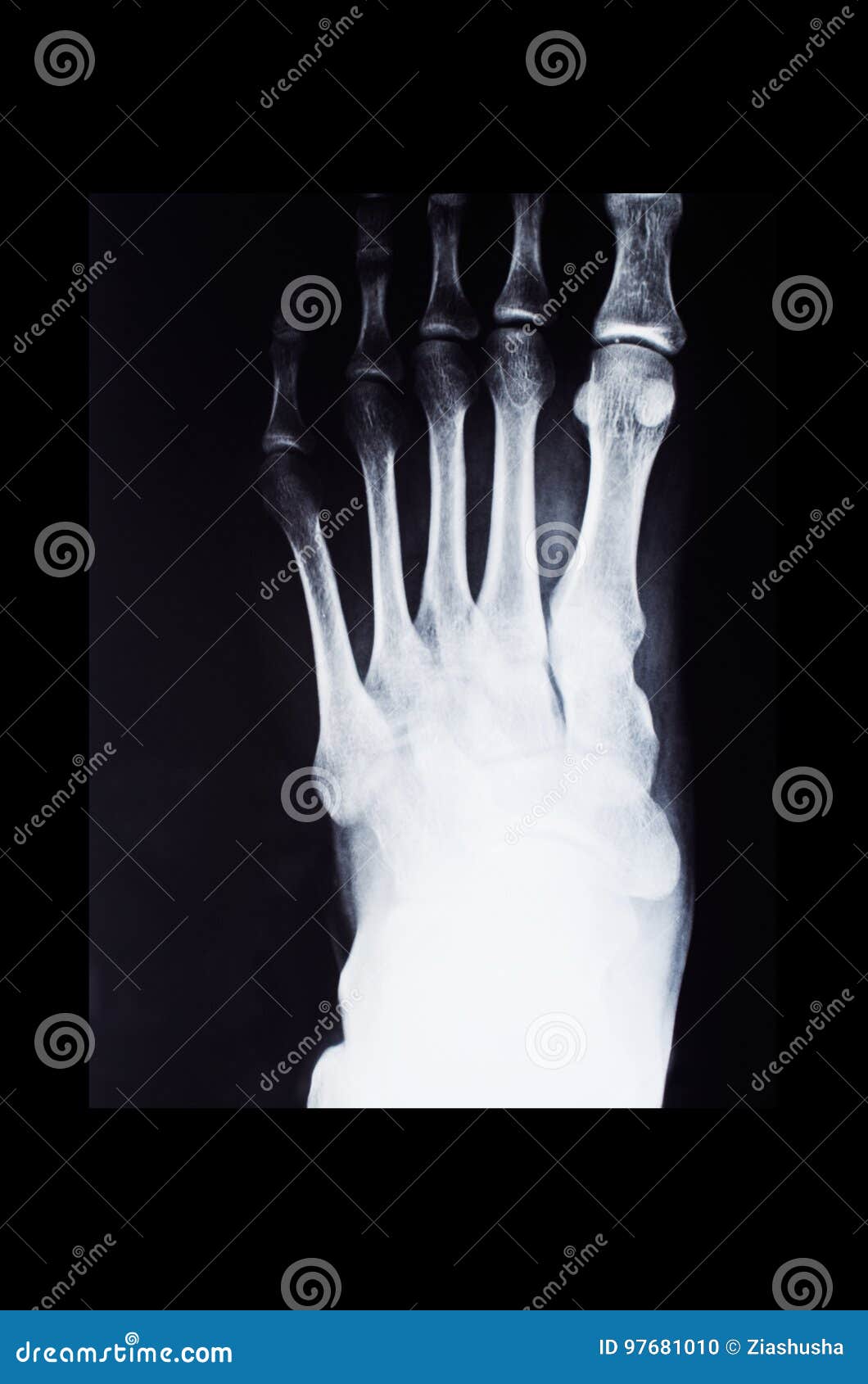 Fluorography of foot stock photo. Image of stage, screen - 97681010