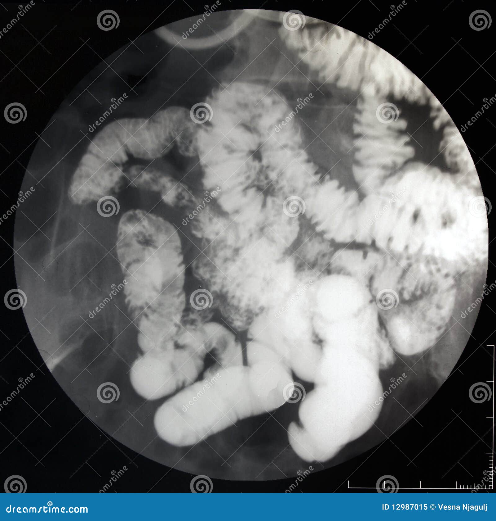 Fluoroscopic X-ray of the Small Intestine Stock Image - Image of life ...