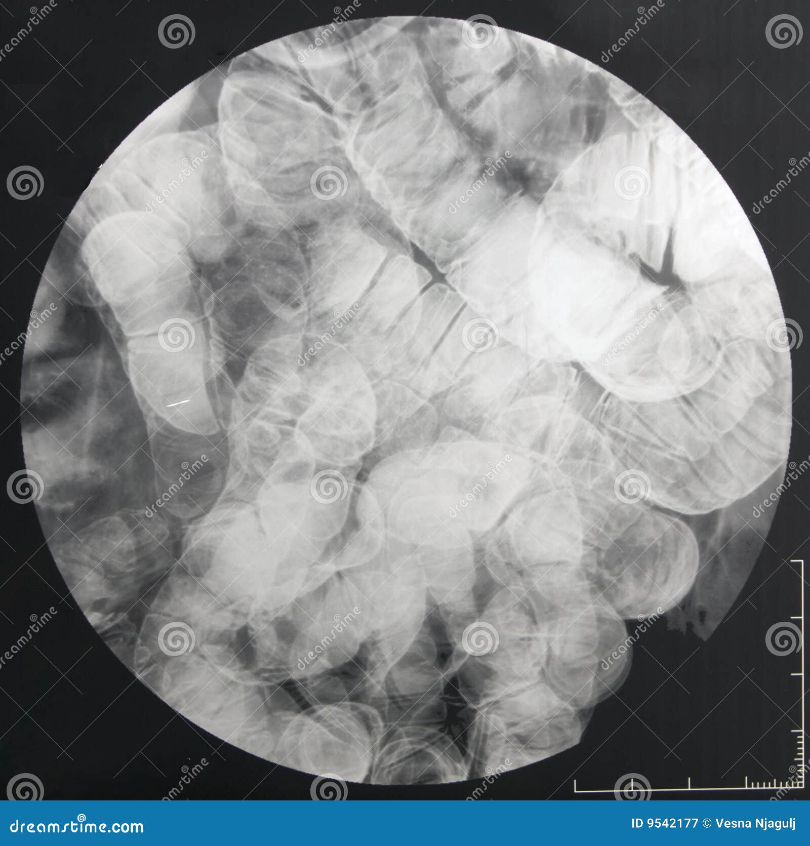 Fluoroscopic X-ray of the Small Intestine Stock Image - Image of injury ...