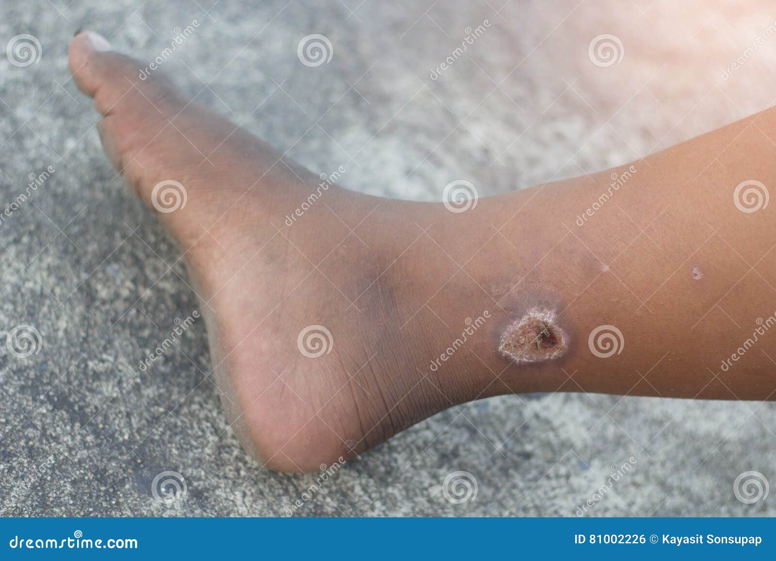 Fly on the wound stock photo. Image of illness, element - 81002226