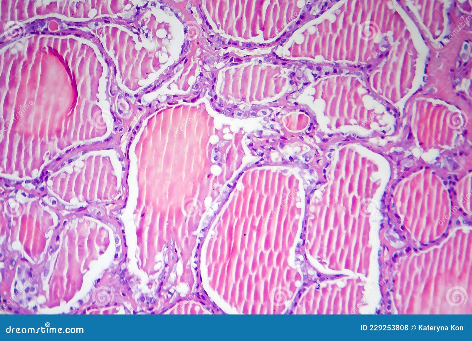 Follicular Adenoma of Thyroid Gland Stock Photo - Image of medical ...