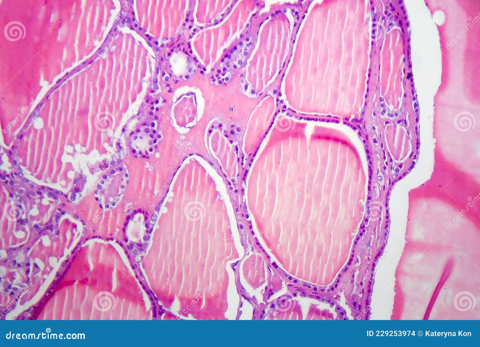 Follicular Adenoma of Thyroid Gland Stock Photo - Image of ...