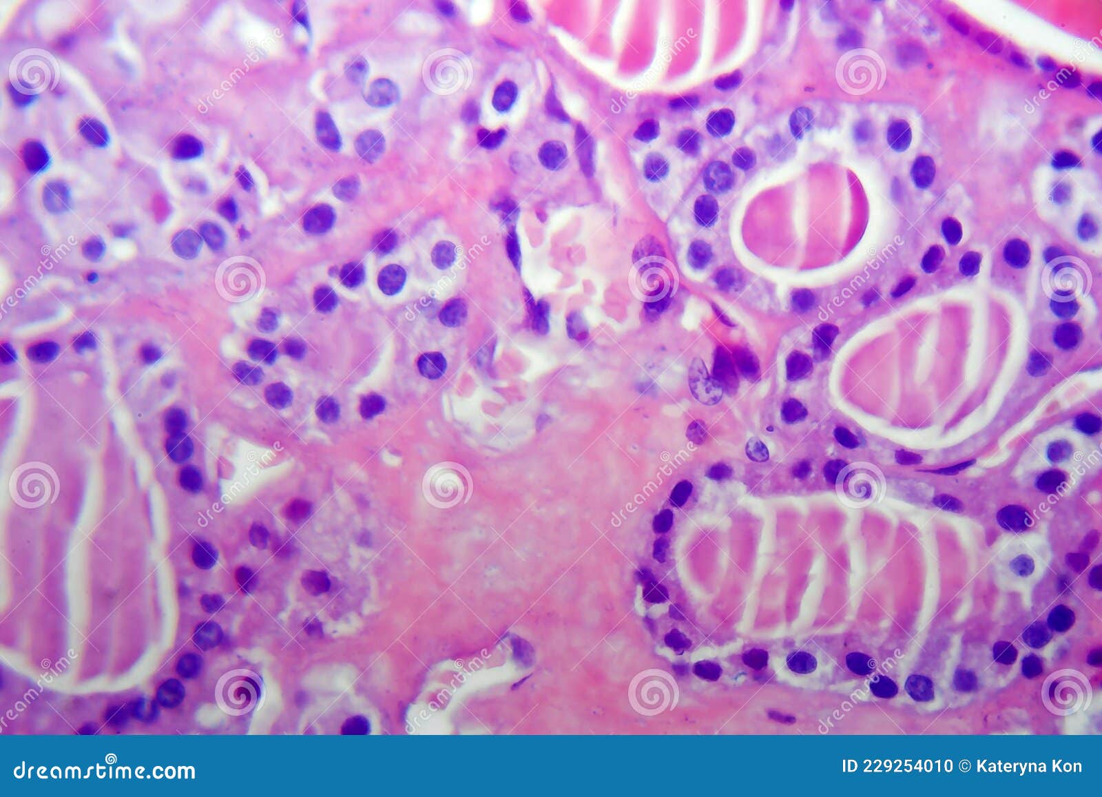 Follicular Adenoma of Thyroid Gland Stock Photo - Image of closeup ...