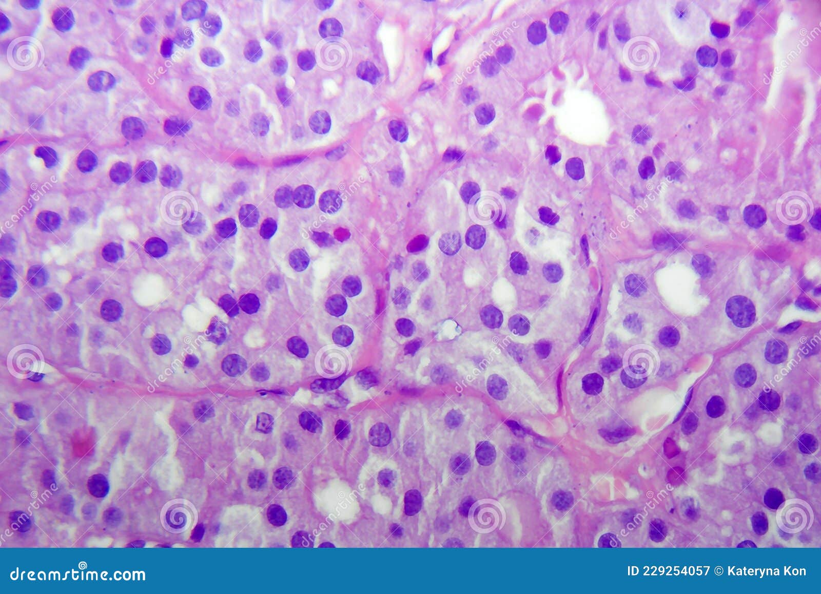Follicular Adenoma of Thyroid Gland Stock Image - Image of sick ...