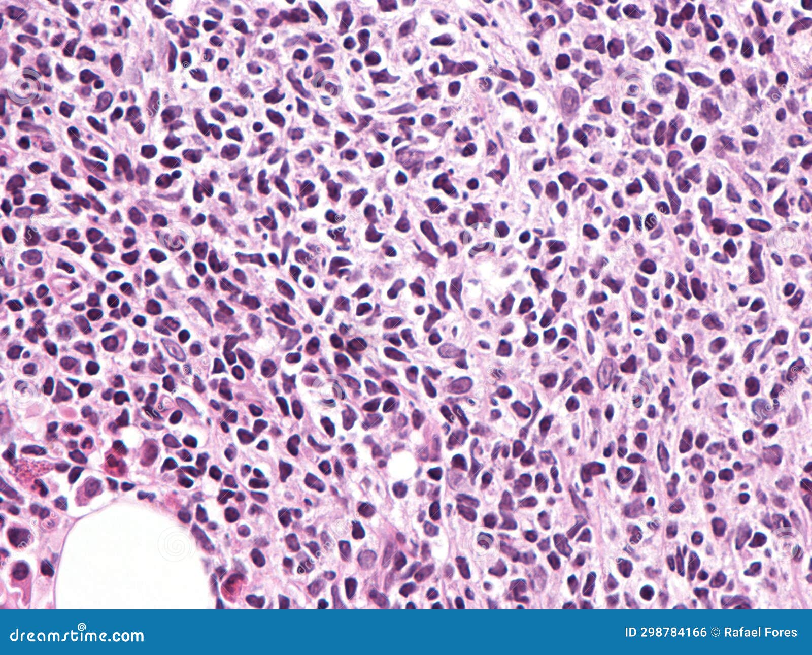 Follicular Lymphoma in Bone Marrow. Stock Photo - Image of clinical ...