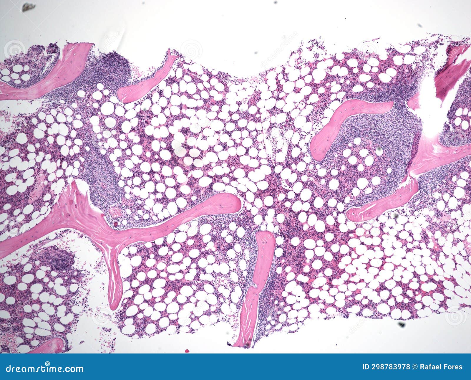 Follicular Lymphoma in Bone Marrow. Stock Photo - Image of pathology ...