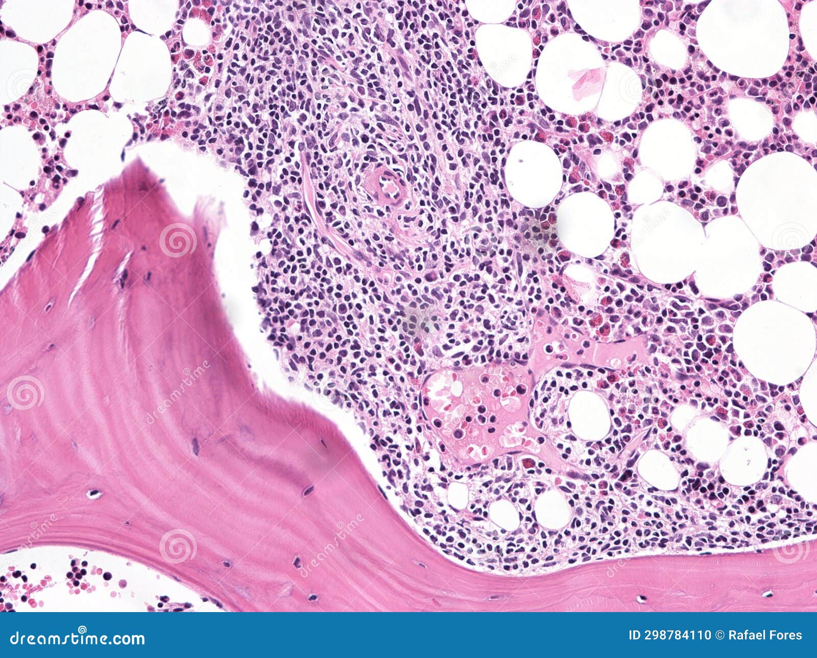 Follicular Lymphoma in Bone Marrow. Stock Photo - Image of marrow ...