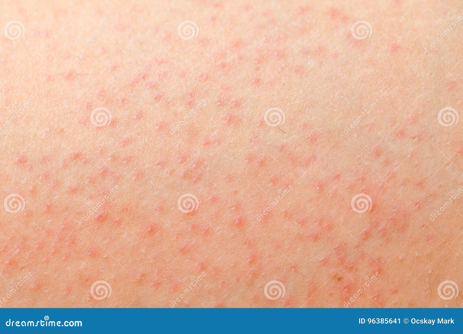 Carbuncle And Folliculitis With Surrounding Cellulitis Or ...