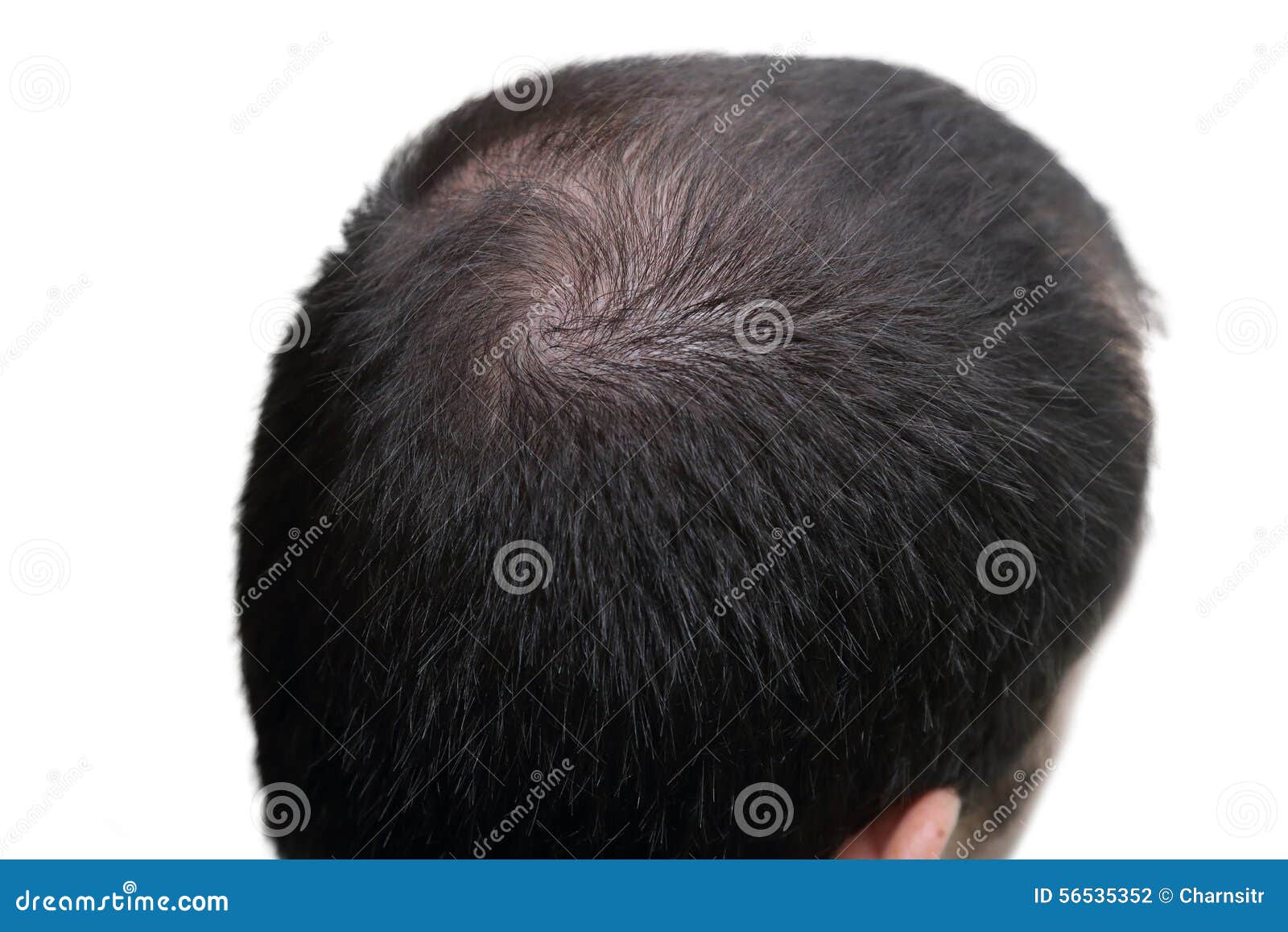 Fondo de la cabeza calva foto de archivo. Imagen de salud - 56535352