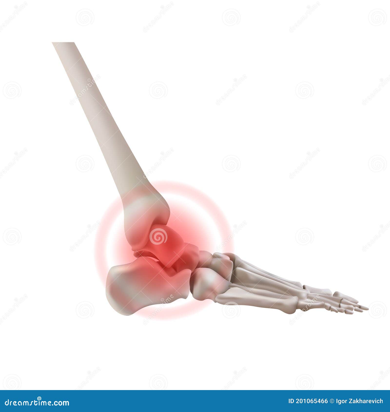 Foot Bone of a Person with Inflamed Arthritis Stock Vector ...