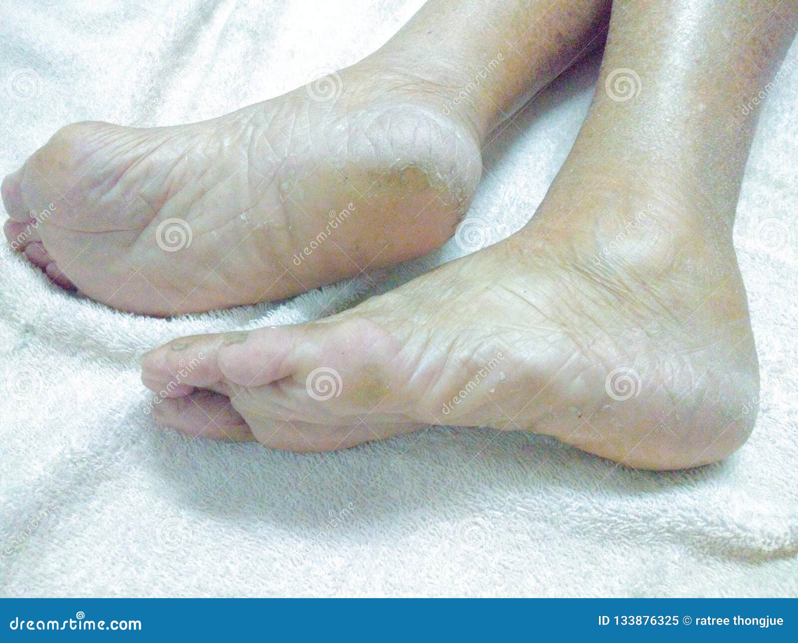 Foot stock image. Image of foot, skin, broken, care - 133876325