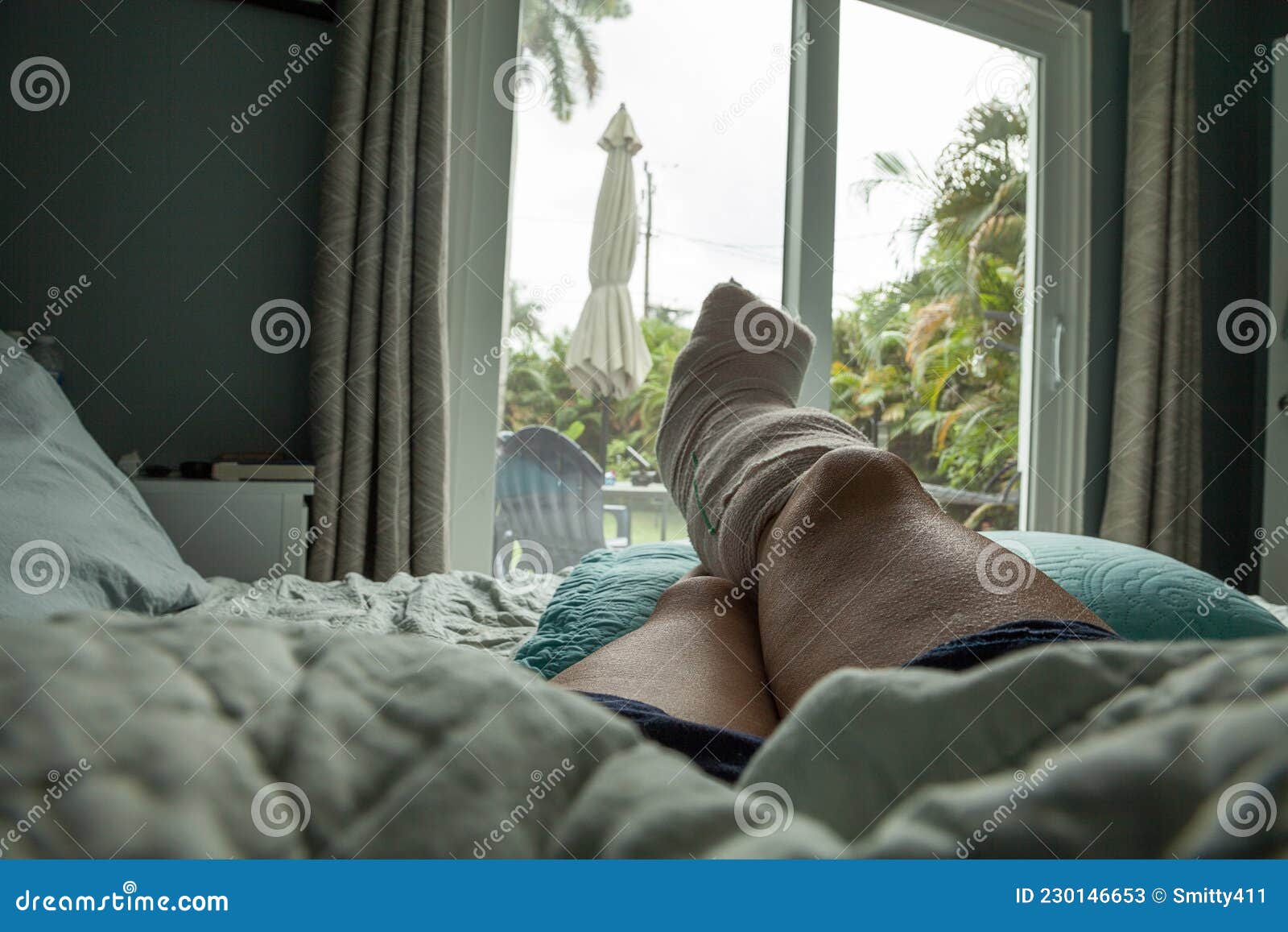 Foot in a Cast after the First Week of Bunion Foot Surgery Stock Image ...