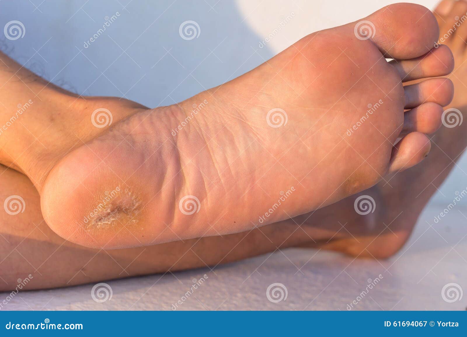 Foot corn stock image. Image of closeup, discomfort, care - 61694067