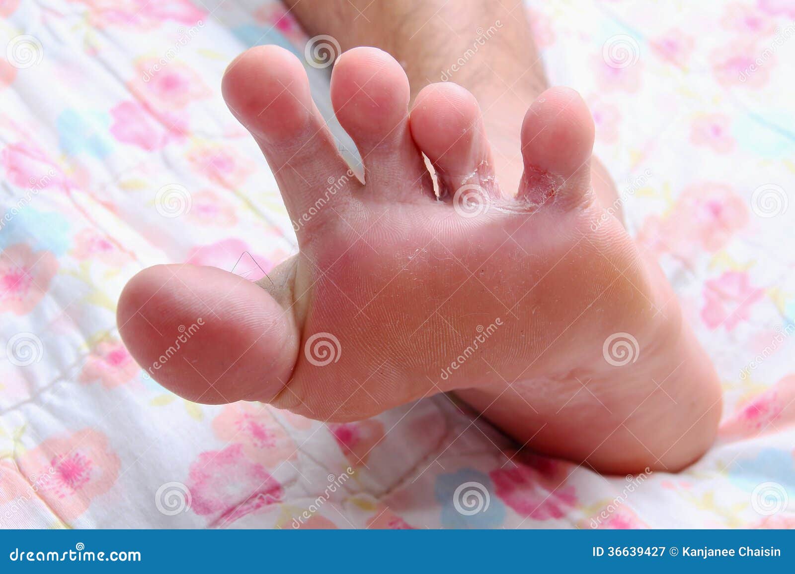 Foot stock image. Image of close, dermatitis, dermatology - 36639427