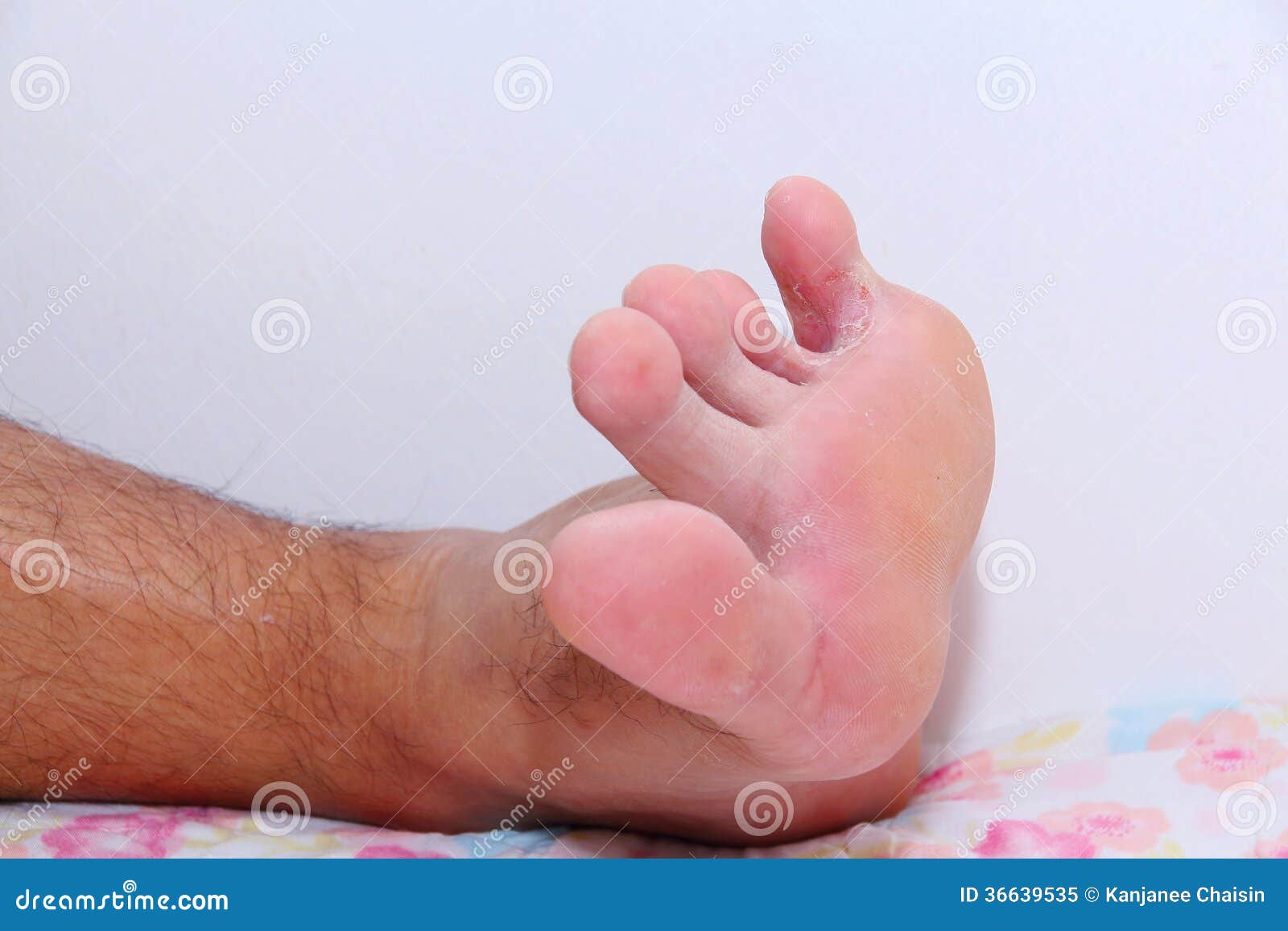 Foot stock image. Image of dermatological, organ, healthcare - 36639535