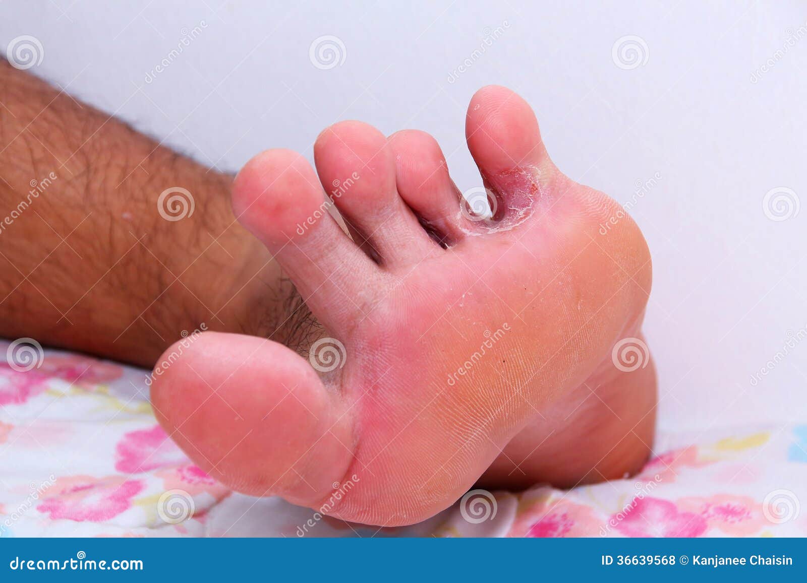 Foot stock photo. Image of tinea, disease, close, sick - 36639568