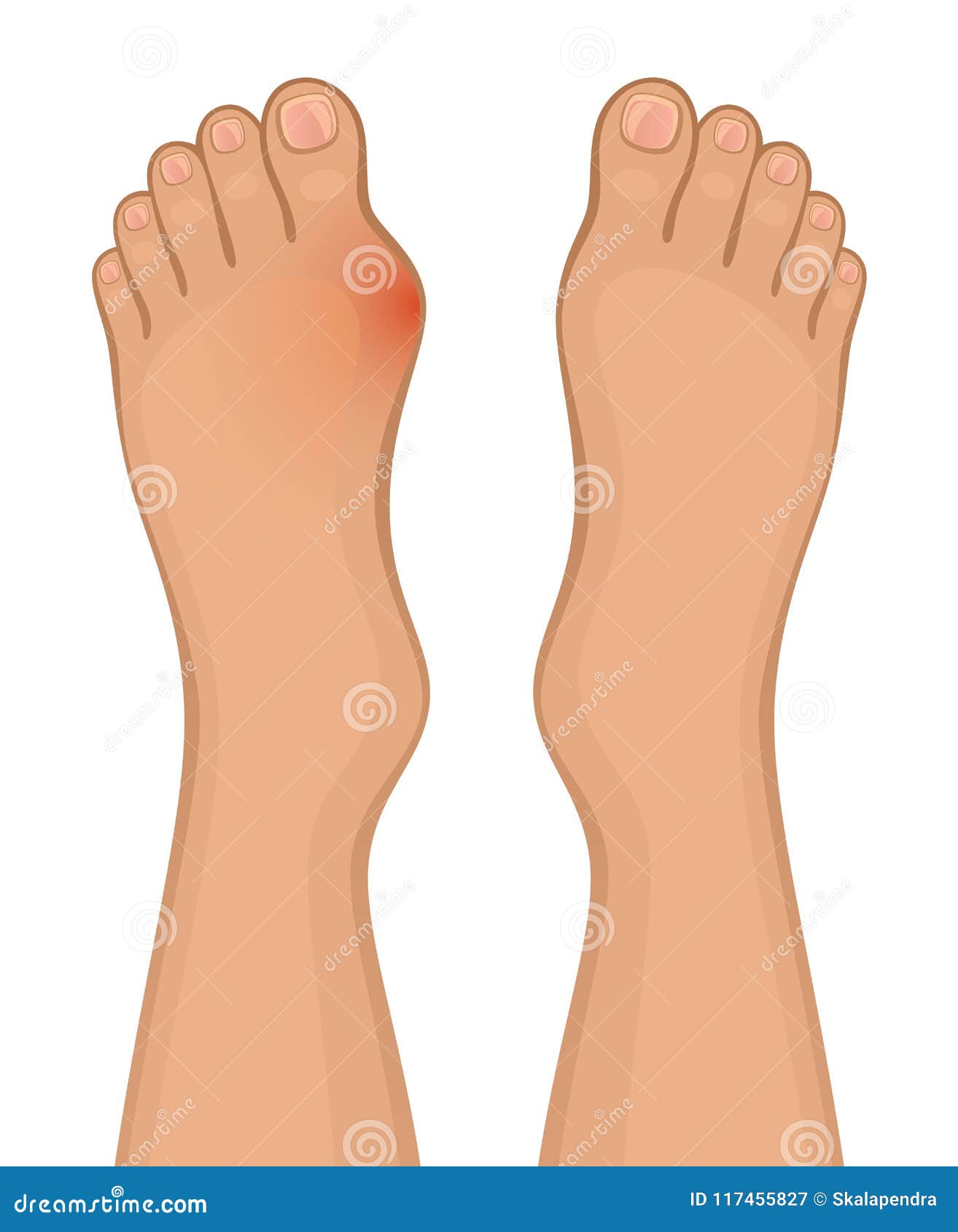 Bump, Swelling Cartoon Legs Isolated On White Background ...