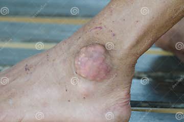 Foot gout stock photo. Image of bone, podagra, arthritis - 47733896