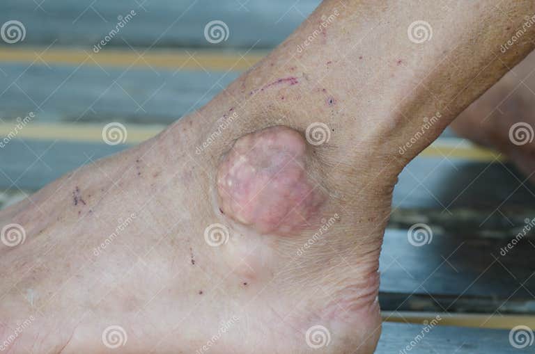 Foot gout stock photo. Image of bone, podagra, arthritis - 47733896