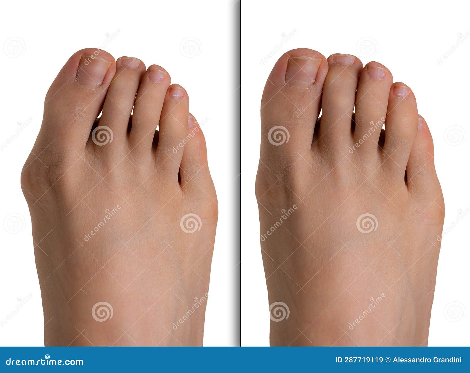 Foot with Hallux Valgus before and after Corrective Surgery Stock Image ...