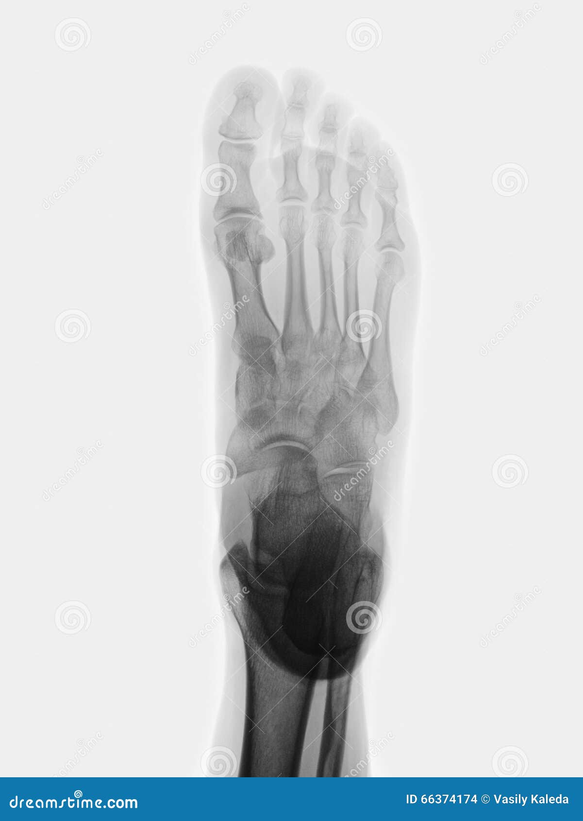 Foot stock photo. Image of bone, football, footstep, roentgen - 66374174