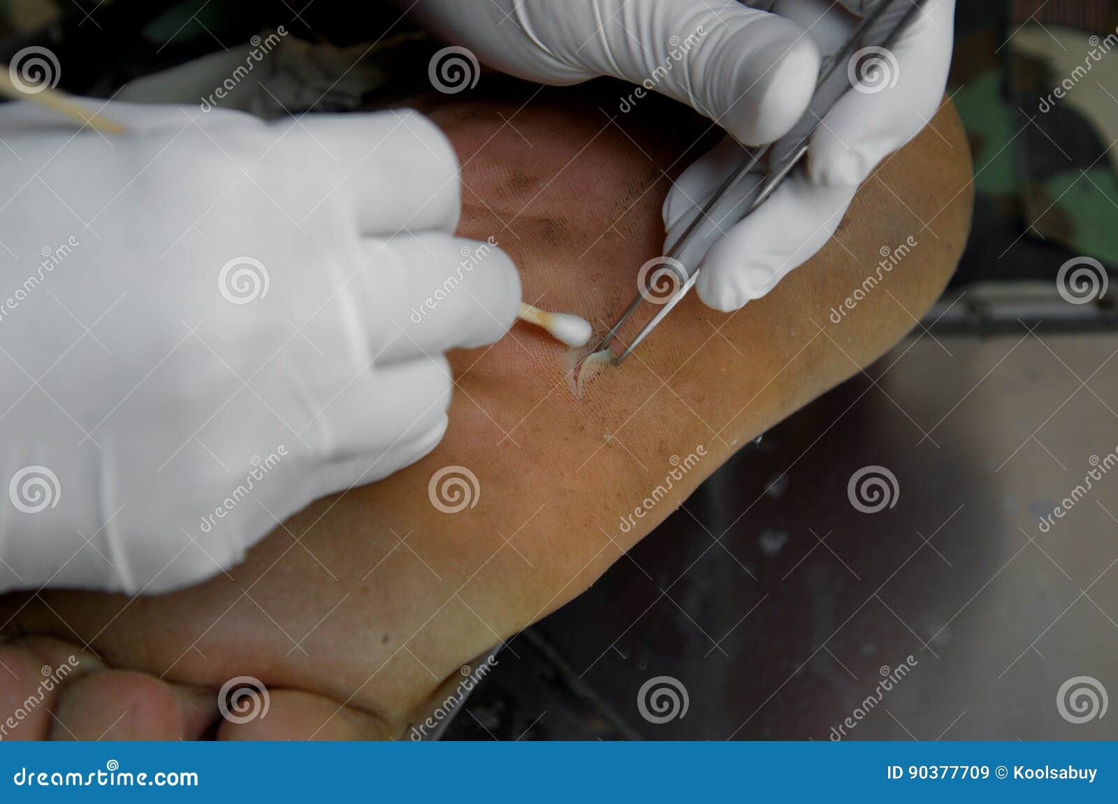 Foot incised wound stock image. Image of swab, sick, pain - 90377709