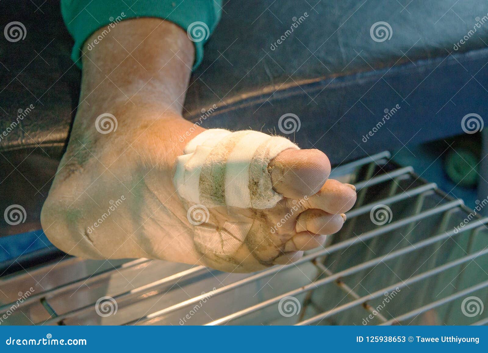 Foot infected wound stock image. Image of health, care - 125938653
