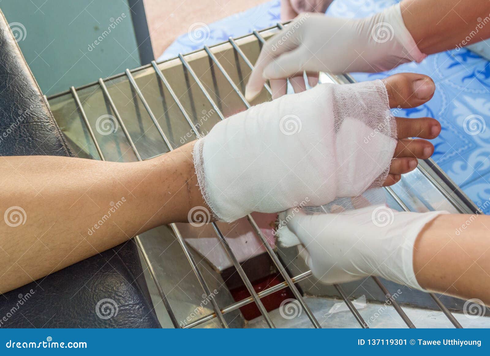 Foot infected wound stock image. Image of tissue, medical - 137119301