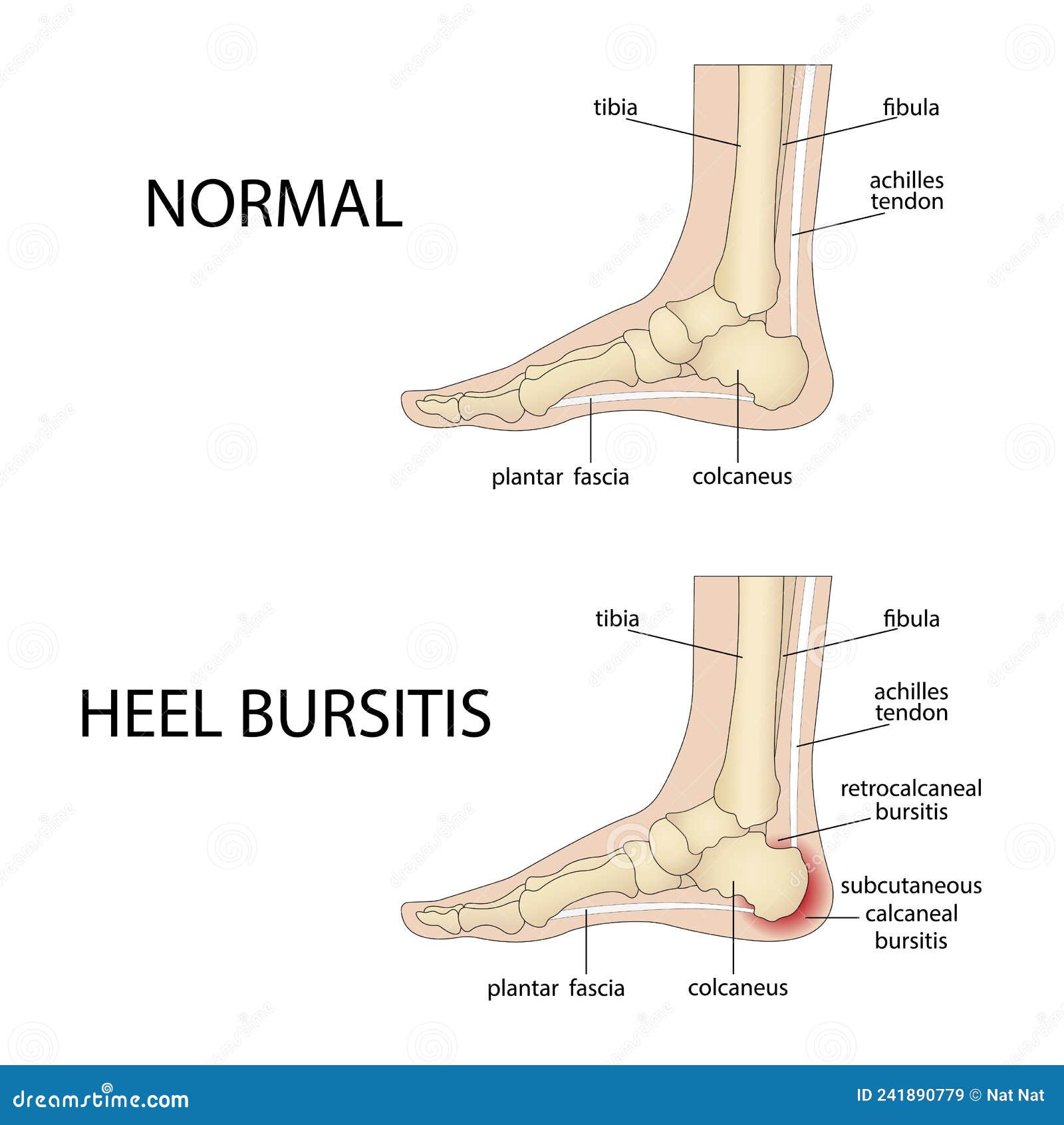 Foot With Normal Heel And Foot With Haglund's Deformity And Bursitis ...